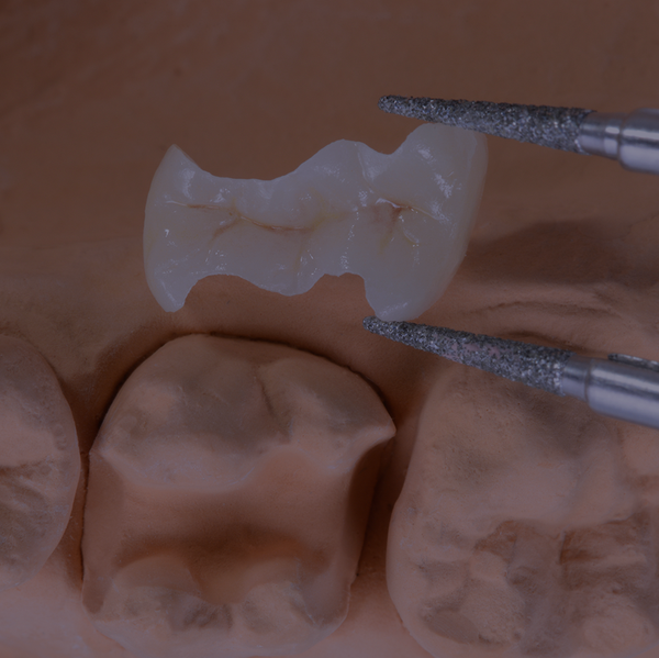 Hybrid Ceramic Inlay – Prime Dental Solutions