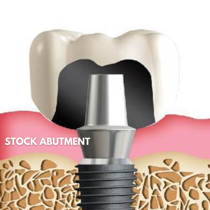 Implant Restorations – Prime Dental Solutions