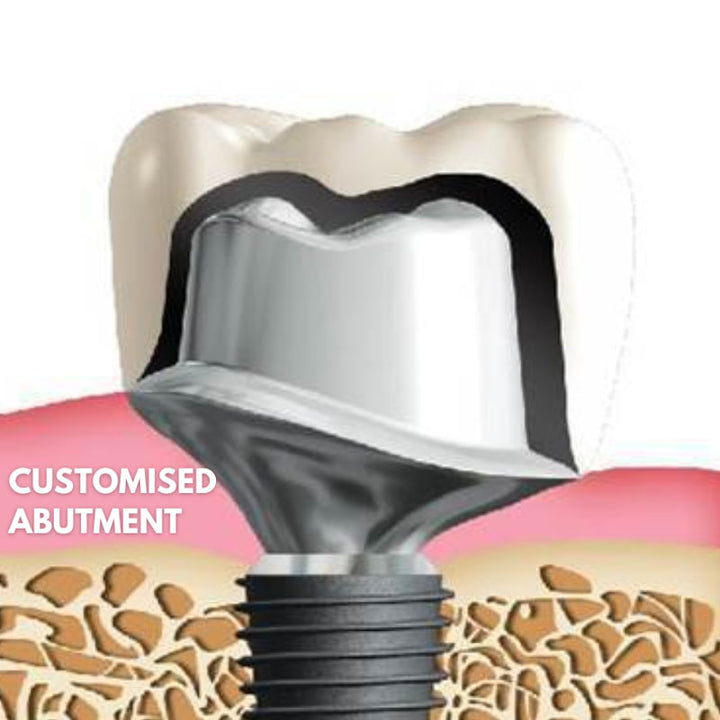 Implant Restorations – Prime Dental Solutions