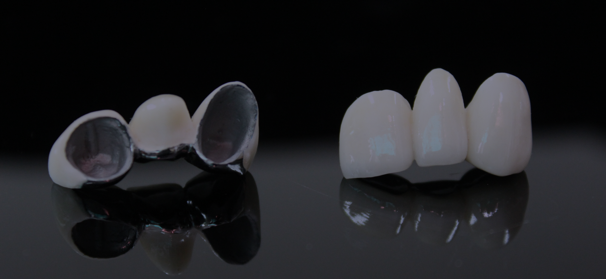 PFM Semi-Precious Crown – Prime Dental Solutions